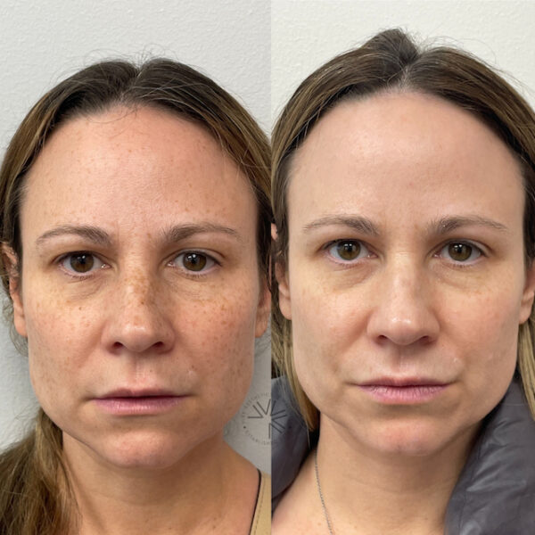 BBL 1 | Vive Aesthetics & Wellness