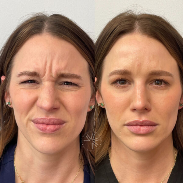 Botox 1 | Vive Aesthetics & Wellness
