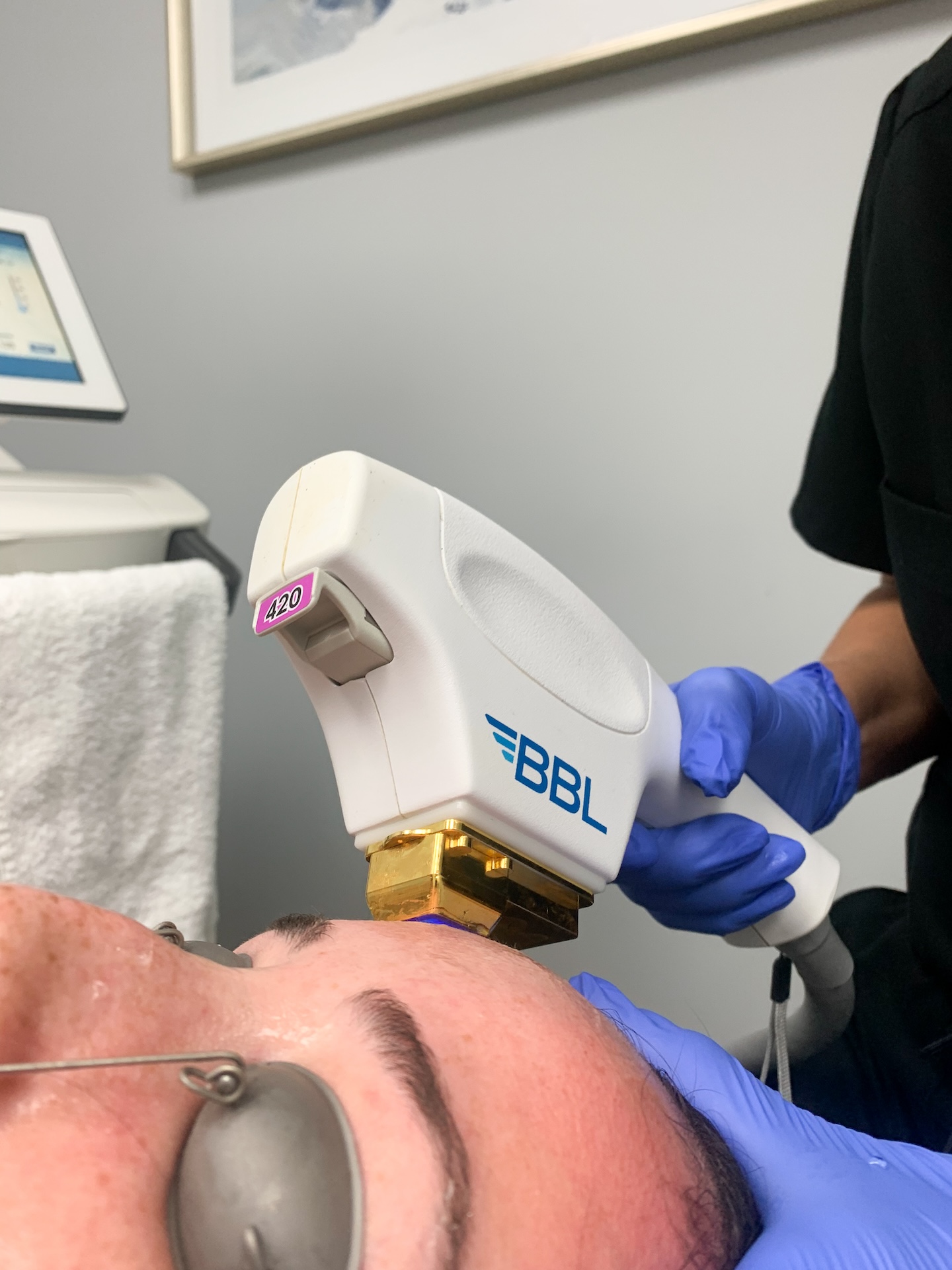 BBL Broadband Light Therapy - Everything You Need to Know | Vive ...